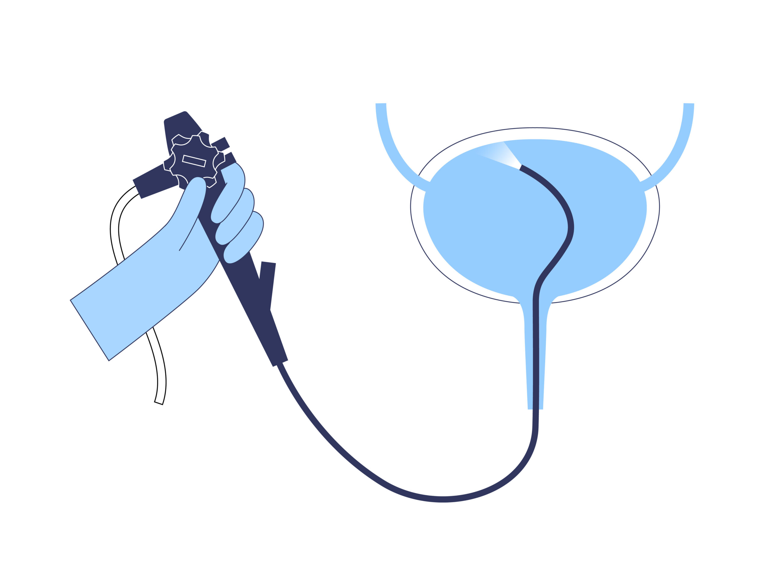 Cystoscopy – Bladder Conditions – Greater Houston Urologists